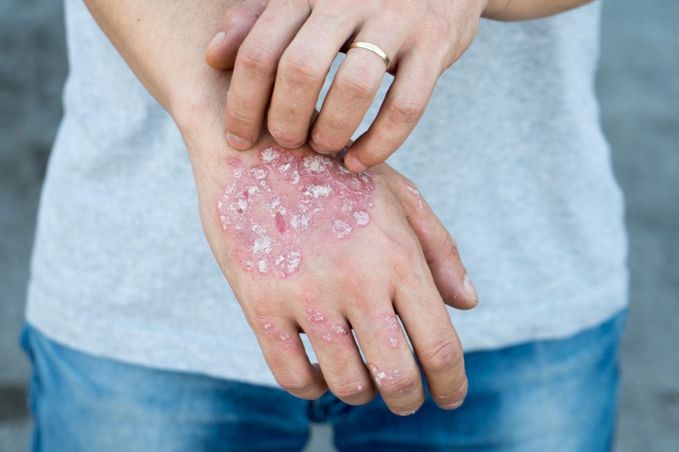Psoriasis, Leaky Gut, and Skin Microbiome: A Complete Guide - ImuPro